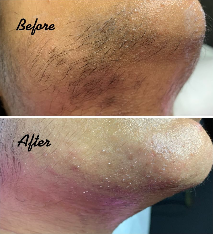Permanent Hair Removal | Electrolysis in San Diego, CA